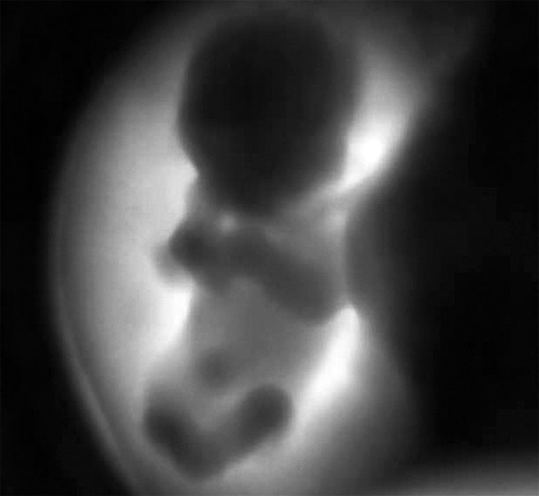 Tidigt ultraljud – Amnionkliniken